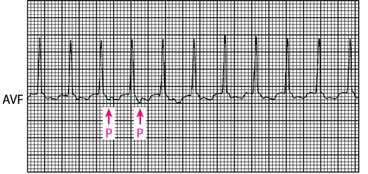 Image:Narrow QRS Tachycardia: Orthodromic Atrioventricular Reentrant ...