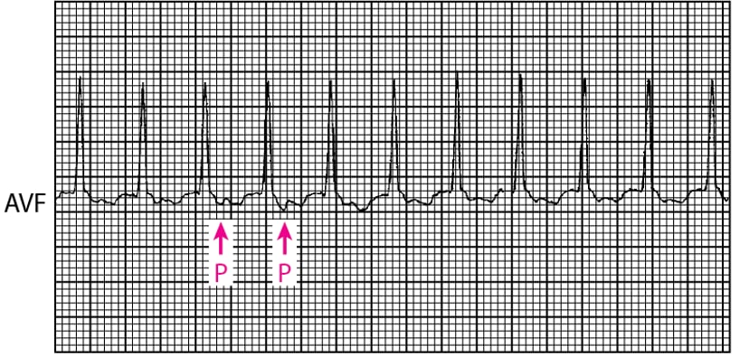 Image:Taquicardia con complejo QRS estrecho: taquicardia recíproca ...
