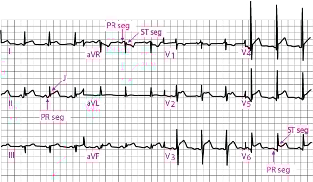 Pericarditis - Cardiovascular Disorders - MSD Manual Professional Edition