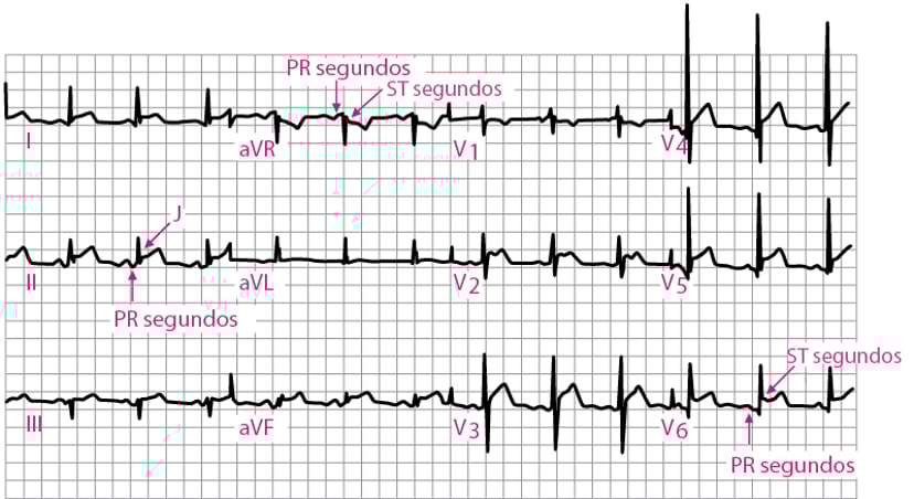 Image:Pericarditis aguda: ECG del estadio 1-Manual Merck versión para ...