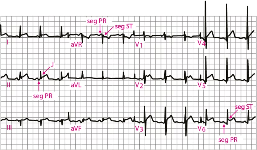 Image:Péricardite aiguë: ECG stade 1-Édition professionnelle du Manuel ...