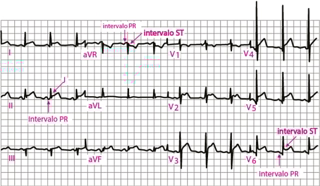 Pericardite - Pericardite - Manuais MSD edição para profissionais