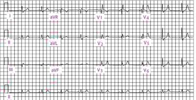 Table: Right Bundle Branch Block-MSD Manual Professional Edition