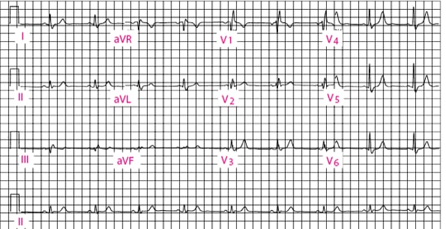 Bundle Branch Block and Fascicular Block - Cardiovascular Disorders ...