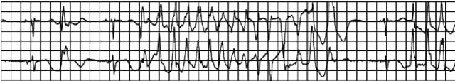 Image:Torsades de pointes ventricular tachycardia-Merck Manual ...