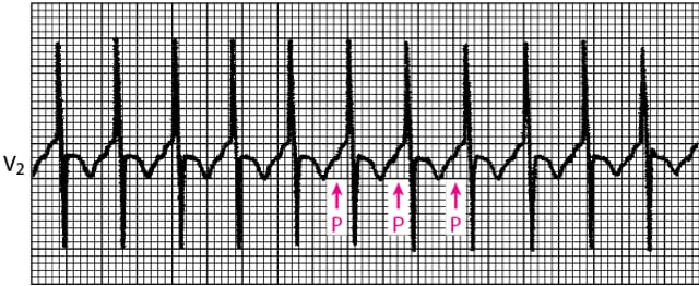 Ectopic Supraventricular Arrhythmias - Ectopic Supraventricular ...