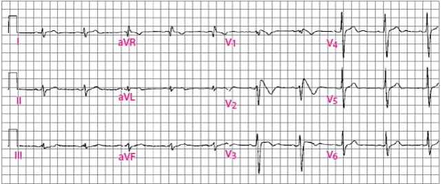 Brugada Syndrome - Cardiovascular Disorders - Merck Manual Professional ...