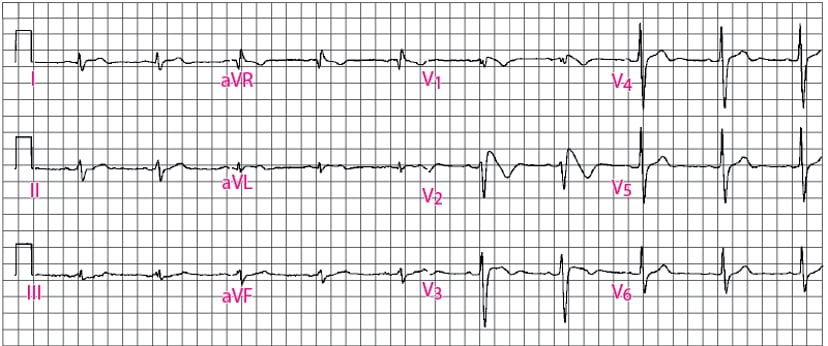 Image:Patrón ECG del síndrome de Brugada tipo 1-Manual MSD versión para ...