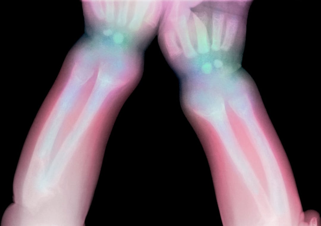 Image:Rickets-Merck Manual Professional Edition