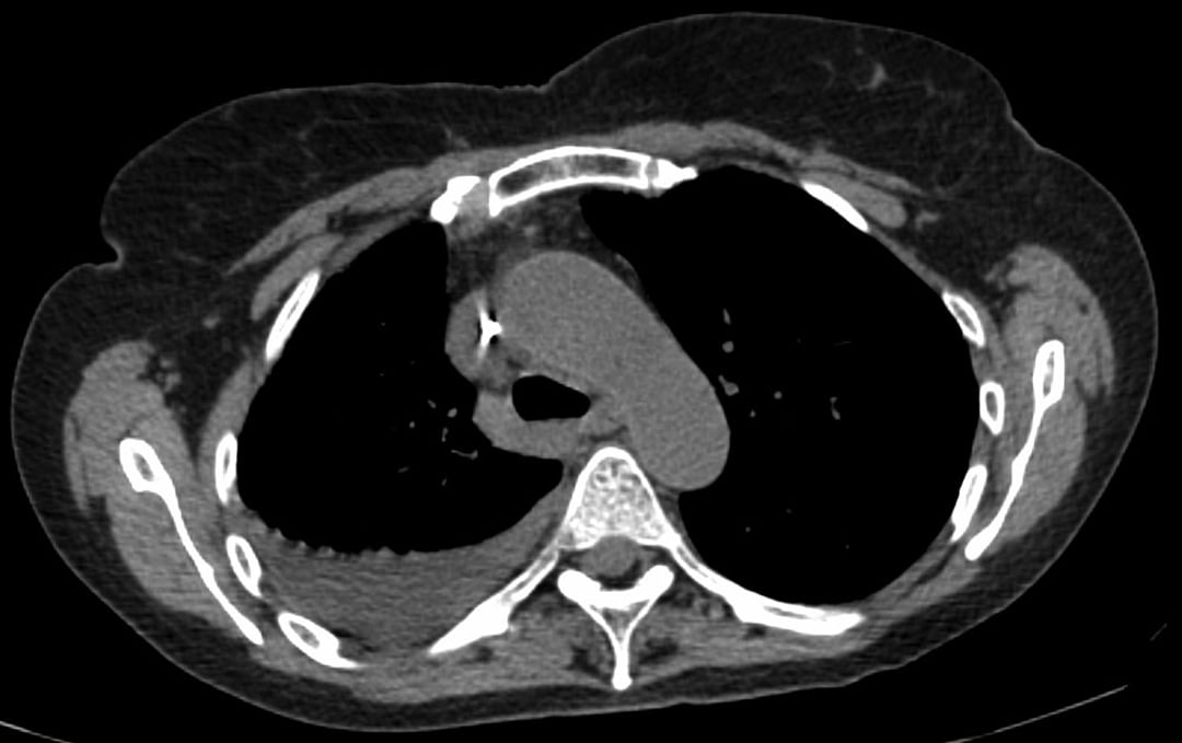 Image:Right Pleural Effusion (CT Scan)-MSD Manual Professional Edition