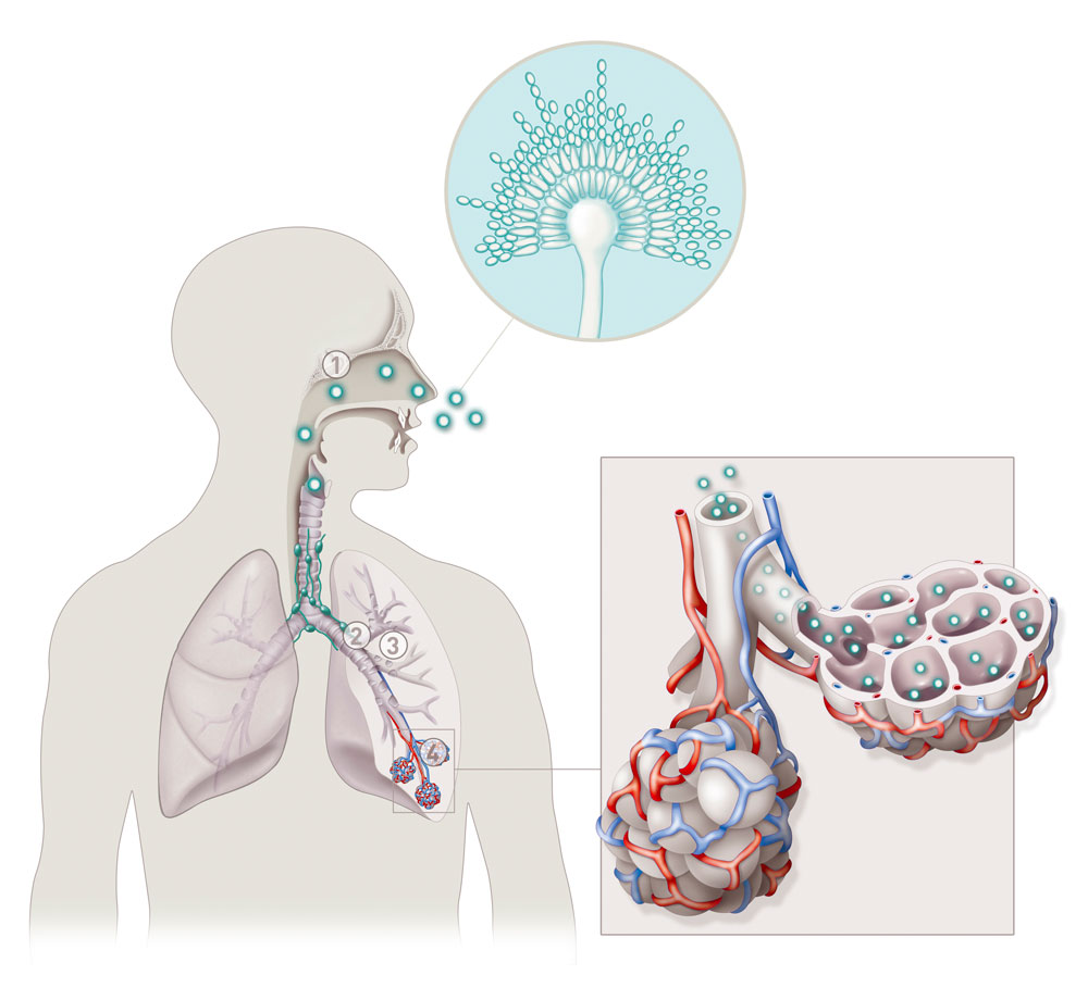 Aspergillosis - Infectious Diseases - Merck Manual Professional Edition