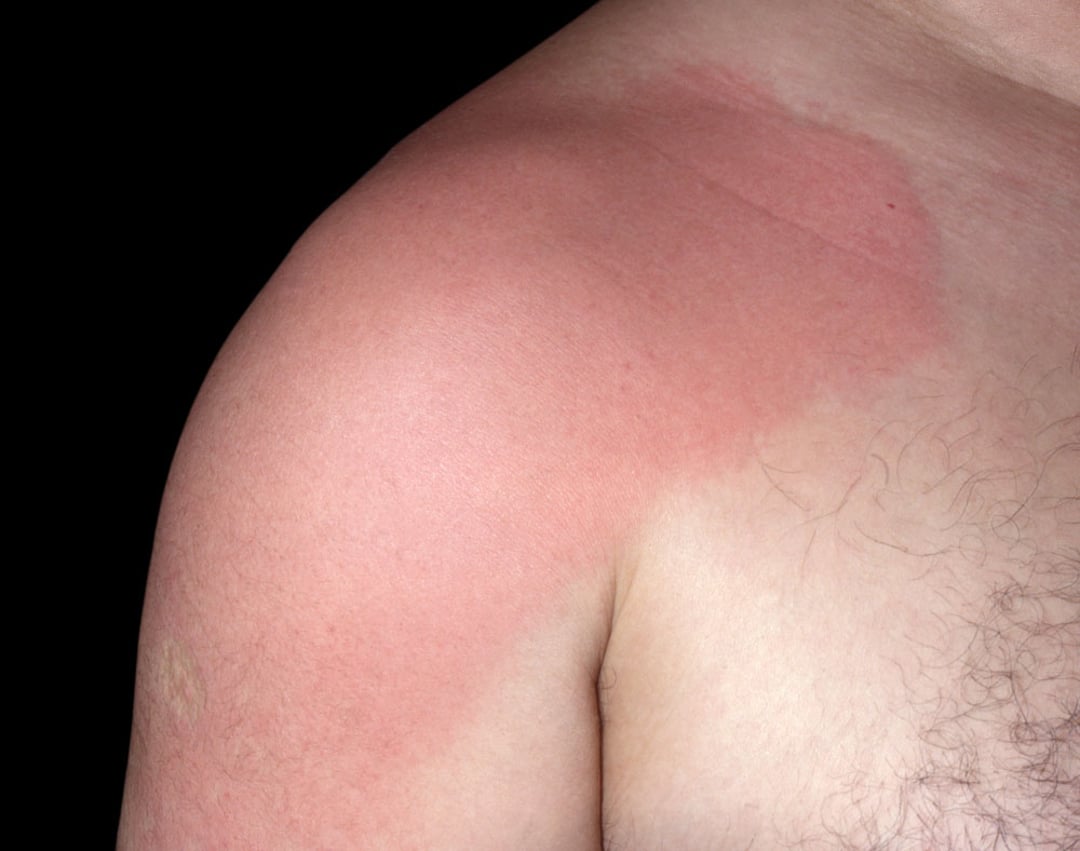 Streptococcal Infections - Infectious Diseases - MSD Manual ...