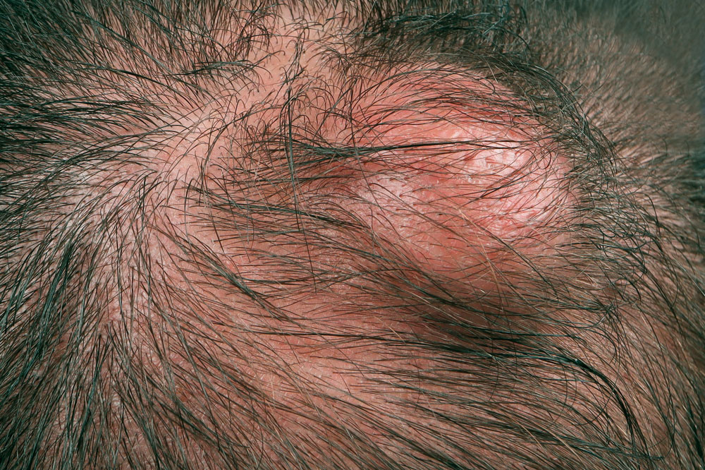 Image:Trichilemmal (Pilar) Cyst-Merck Manual Professional Edition