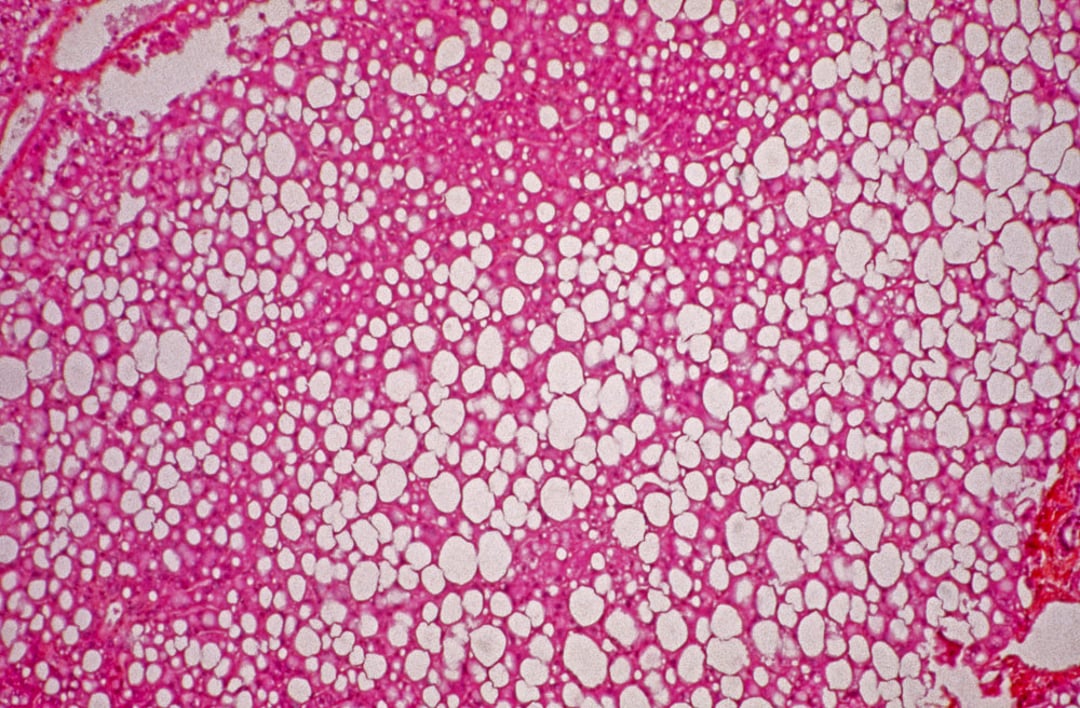 Hépatopathie alcoolique - Troubles hépatiques et biliaires - Édition ...