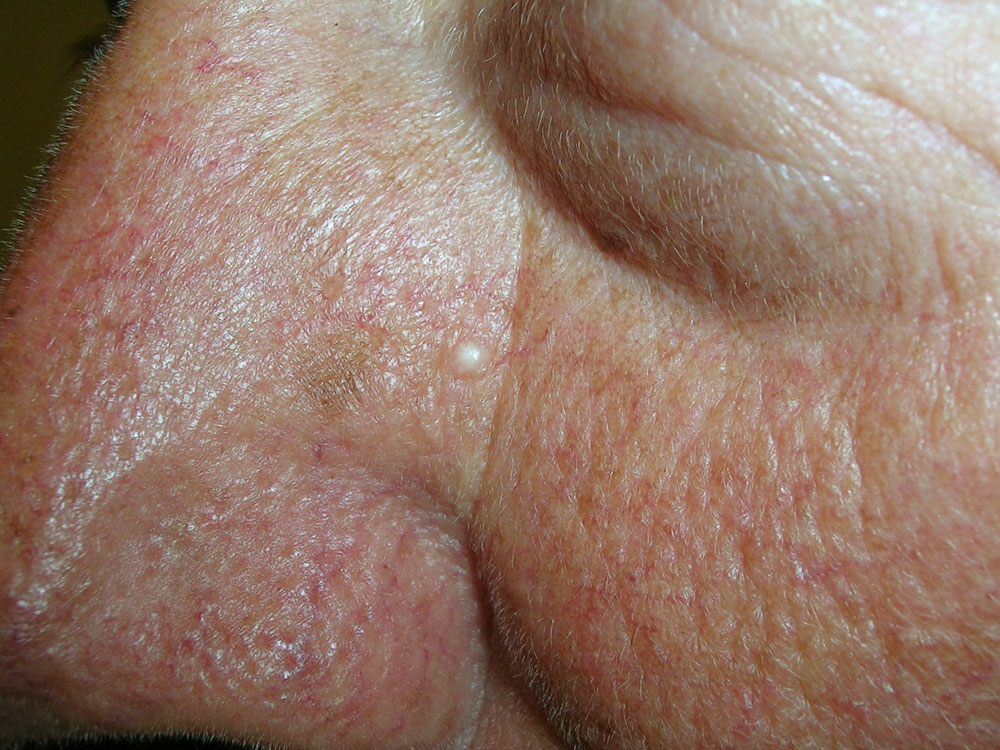 Cutaneous Cysts - Dermatologic Disorders - Merck Manual Professional ...