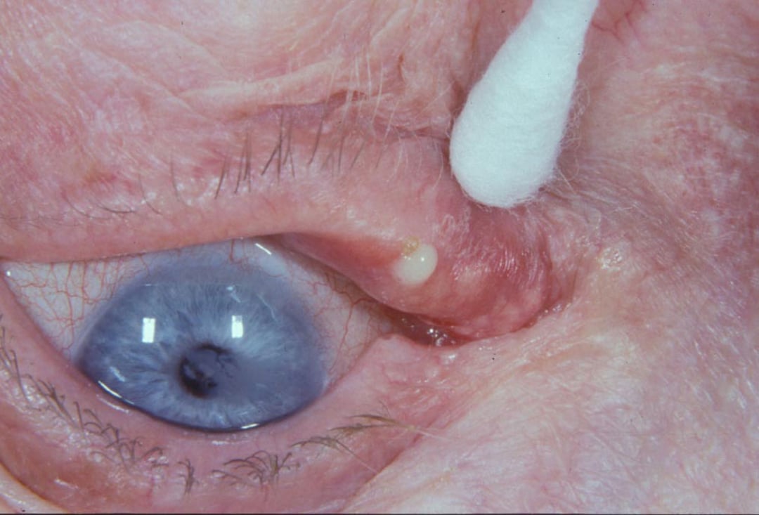 Canaliculitis - Ophthalmology - Merck Manual Professional Edition