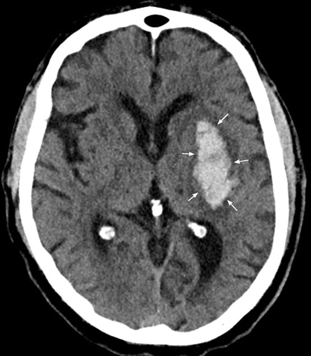 Image Ct Of The Head Msd Manual Professional Edition