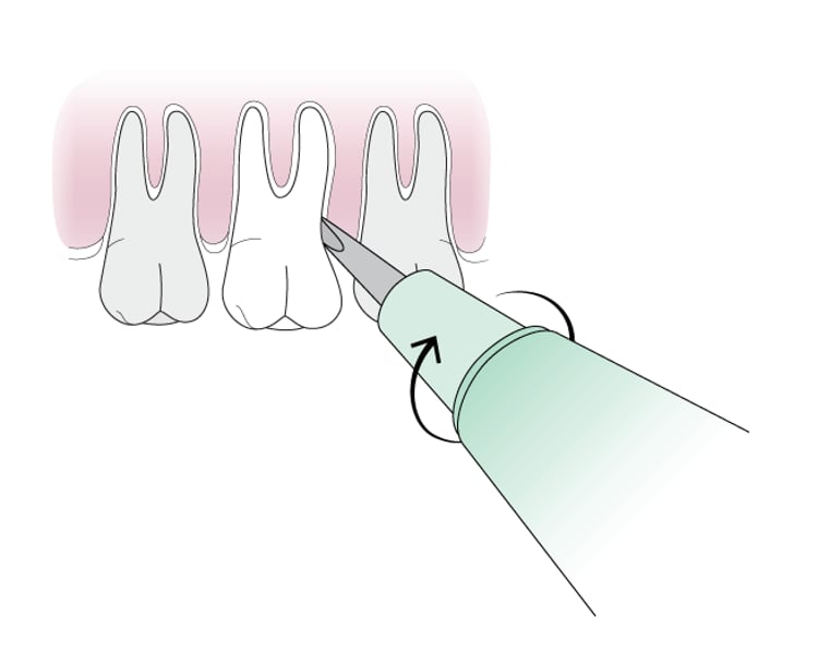 How To Do an Emergency Tooth Extraction - Dental Disorders - MSD Manual ...