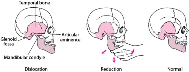 Image:Mandibular reduction-Merck Manual Professional Edition