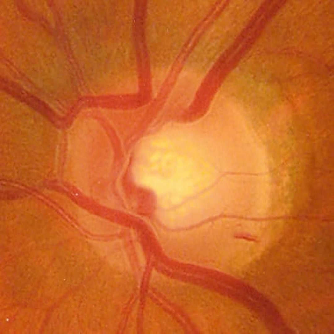 Primary Open-Angle Glaucoma - Ophthalmology - Merck Manual Professional ...