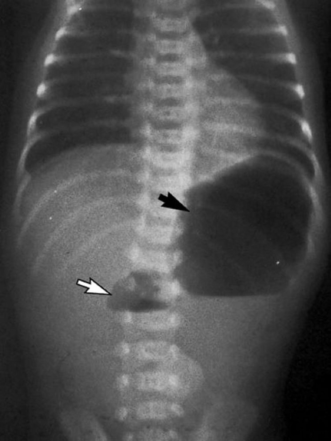 Image:double-bubble sign-MSDマニュアル プロフェッショナル版