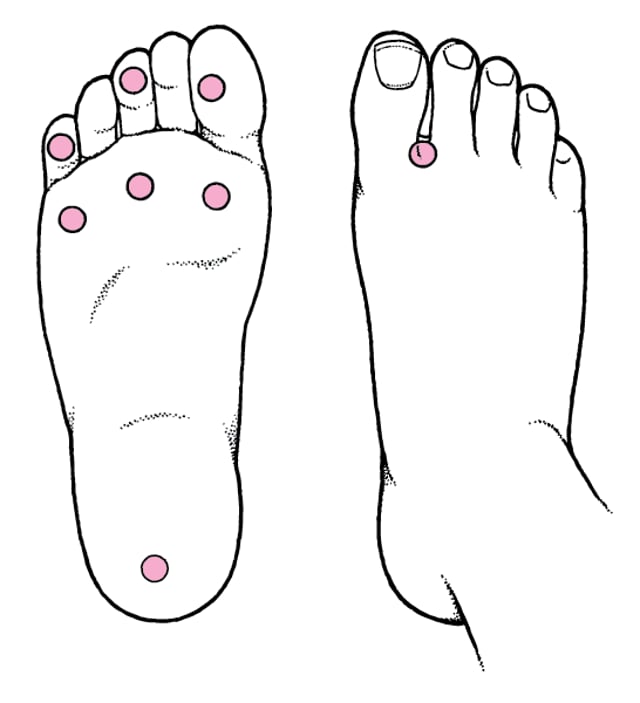 Long-Term Complications of Diabetes Mellitus - Endocrinology - Merck ...