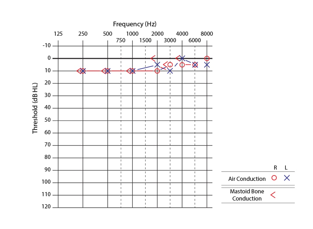 Image:Audiogram of Right Ear in a Patient with Normal Hearing-MSD ...