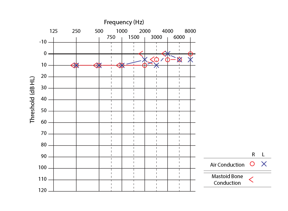 Image:Audiograma del oído derecho en un paciente con audición normal-Manual MSD versión para ...
