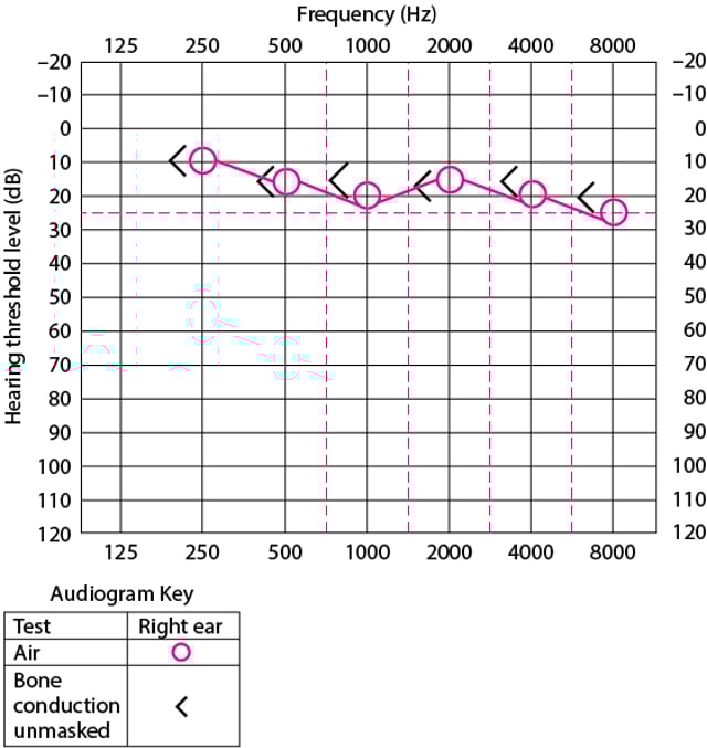 Image:Audiogram of right ear in a patient with normal hearing-MSD ...