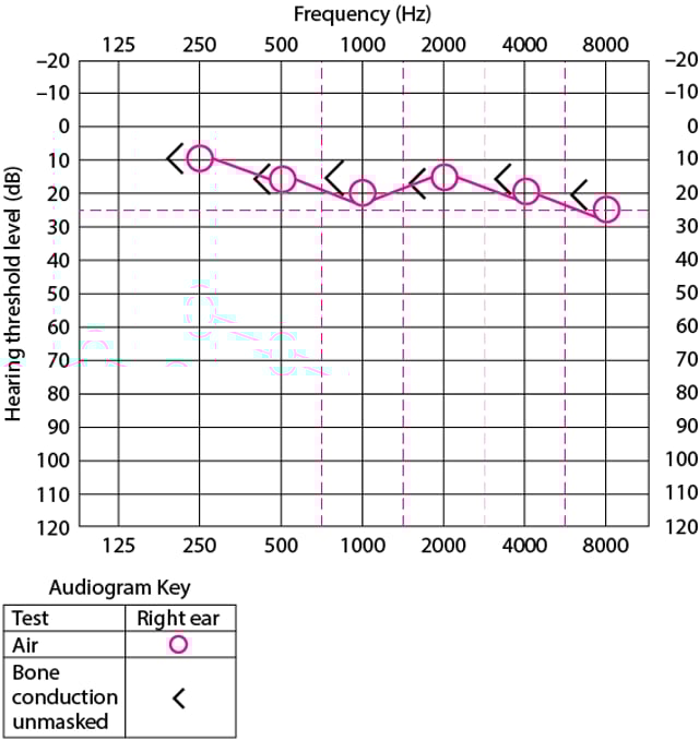 Image:Audiograma del oído derecho en un paciente con audición normal ...