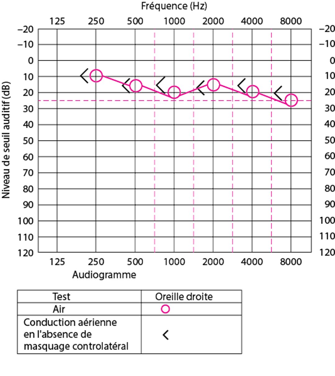 Image:Audiogramme de l'oreille droite chez un patient dont l'audition ...