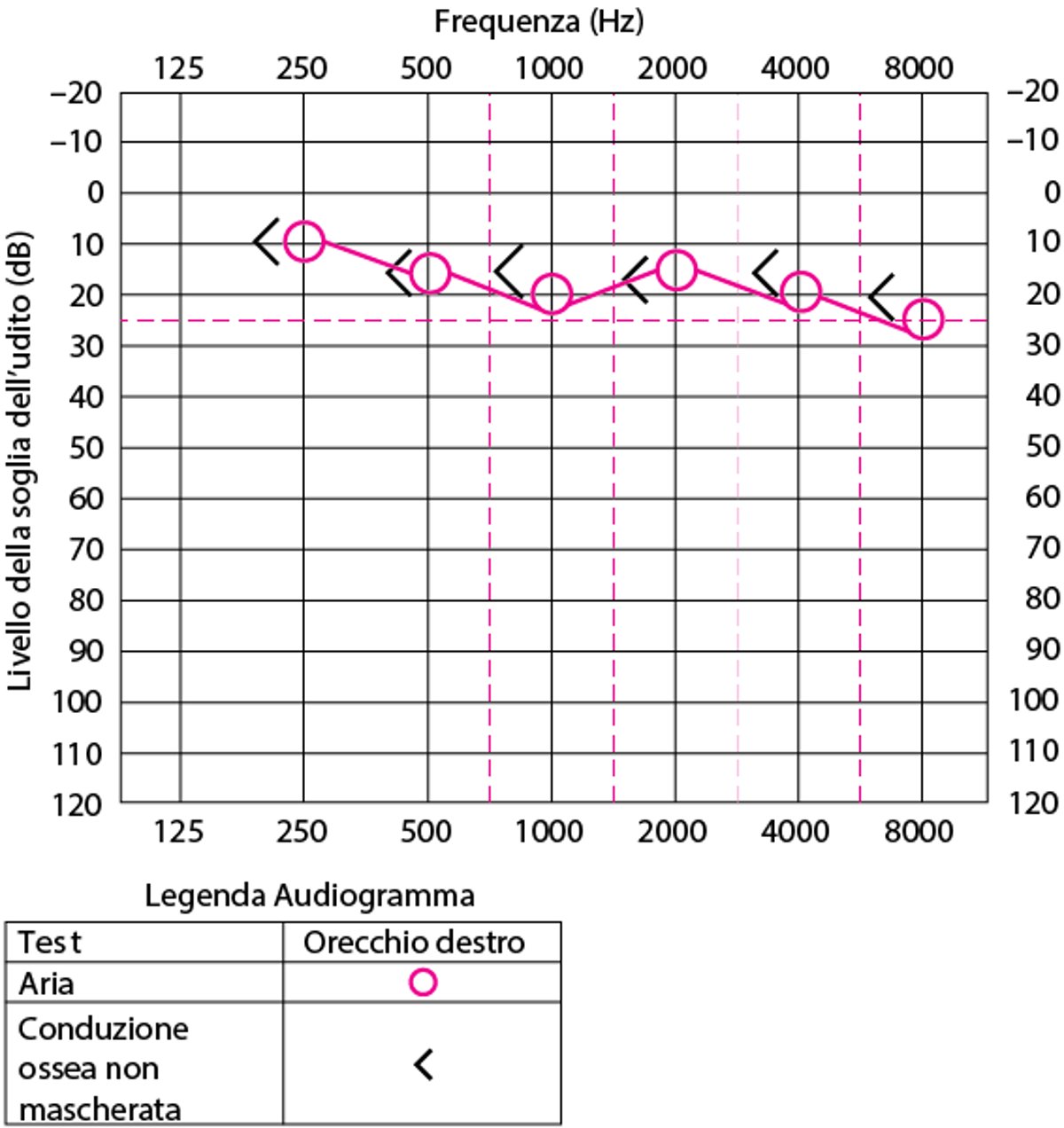 Image:Audiogramma dell'orecchio destro di un paziente normoacusico ...