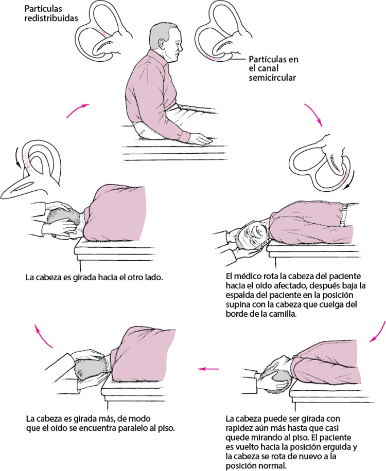 Vértigo posicional paroxístico benigno - Trastornos ...