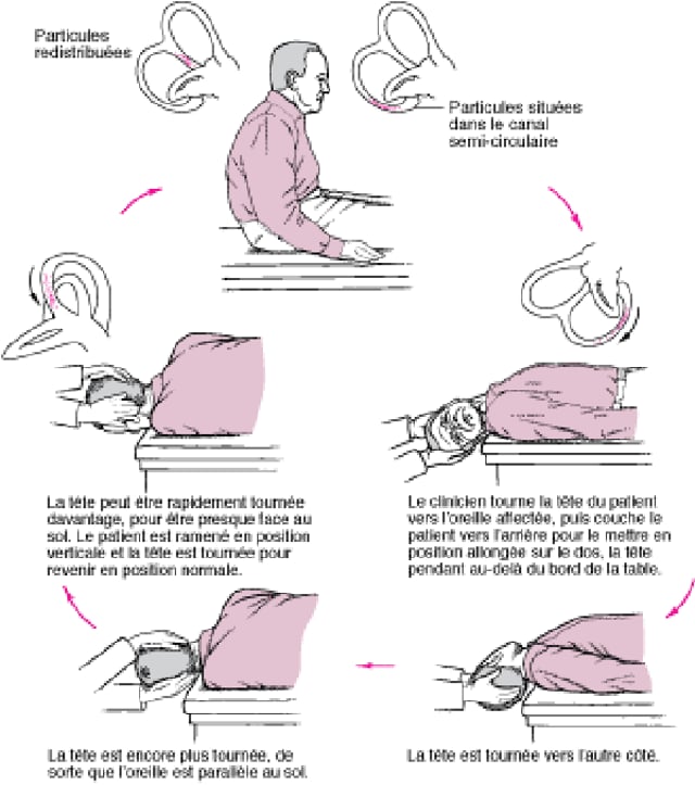 Vertiges positionnels paroxystiques bénins - Affections de l'oreille ...