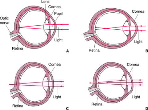 Overview of Refractive Error - Eye Disorders - MSD Manual Professional ...