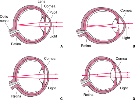 Overview of Refractive Error - Eye Disorders - MSD Manual Professional Edition