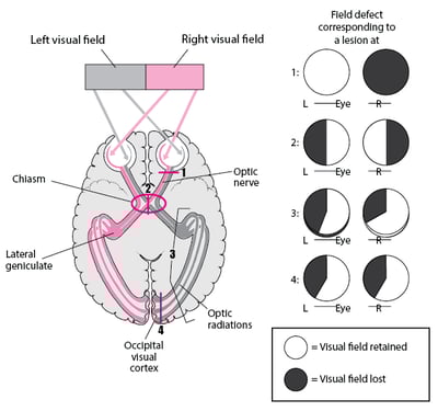 Table: Higher Visual Pathways—Lesion Sites and Corresponding Visual ...