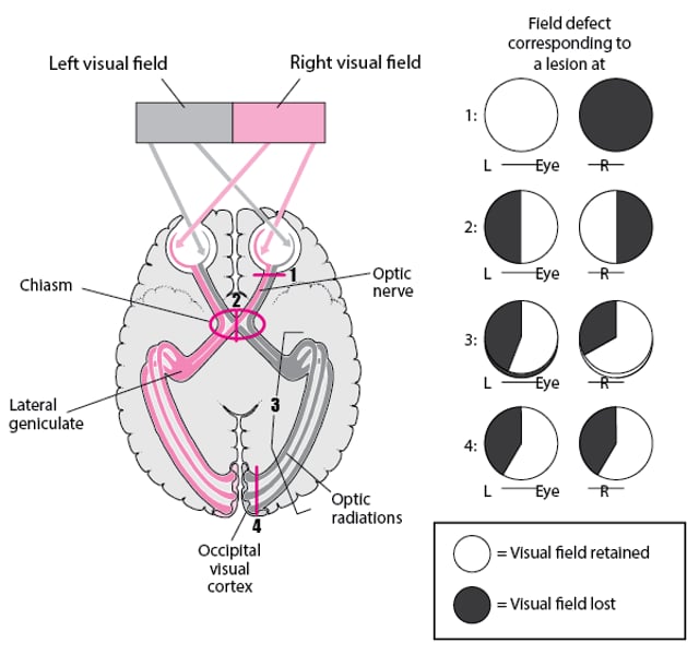 Image:Higher Visual Pathways—Lesion Sites and Corresponding Visual ...