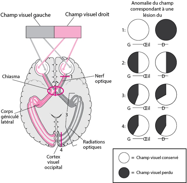 Voies optiques - Troubles oculaires - Édition professionnelle du Manuel MSD