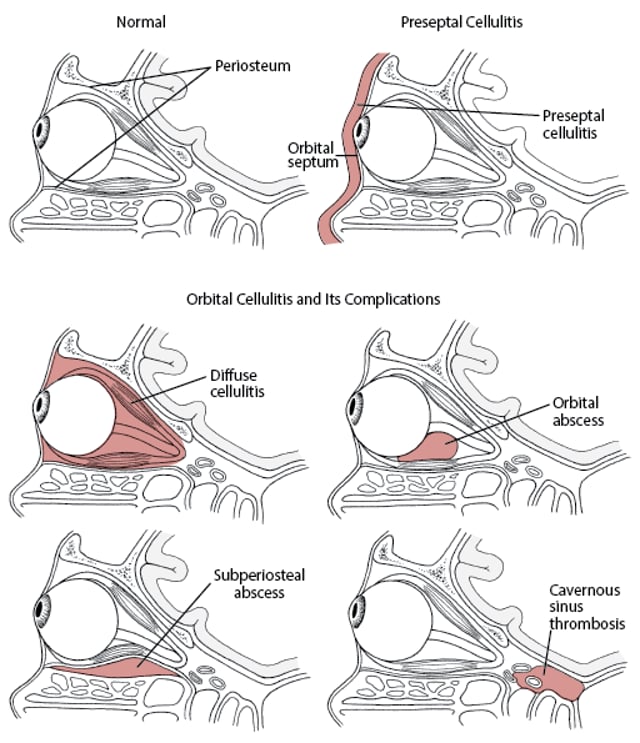 Preseptal and Orbital Cellulitis - Eye Disorders - MSD Manual ...