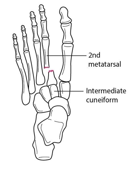 Image:Fracture of the 2nd metatarsal base with tarsometatarsal joint ...