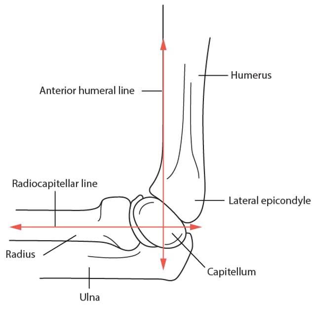Radial Head Fractures - Radial Head Fractures - MSD Manual Professional ...