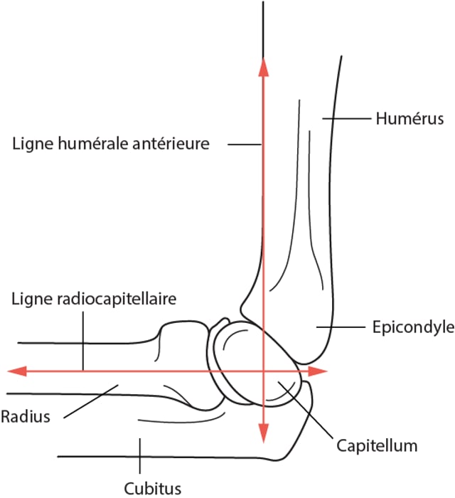 Fractures distales de l'humérus - Blessures; empoisonnement - Édition ...