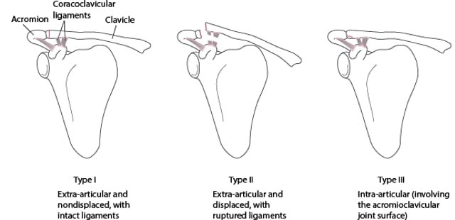 Clavicle Fractures - Injuries; Poisoning - MSD Manual Professional Edition