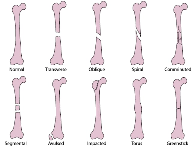 Image:Common types of fracture lines-MSD Manual Professional Edition