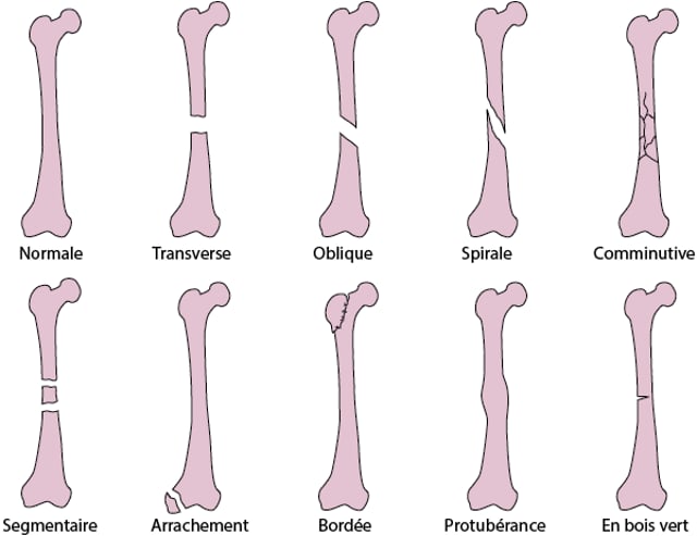 Revue générale des fractures - Blessures; empoisonnement - Édition ...