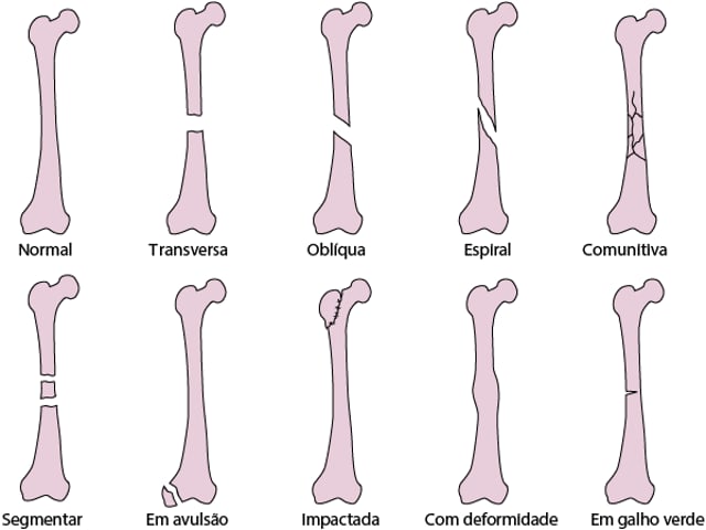 Visão geral das fraturas - Lesões; intoxicação - Manuais MSD edição ...