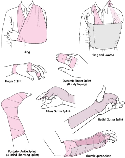 Image:Joint immobilization as acute treatment: Some commonly used ...