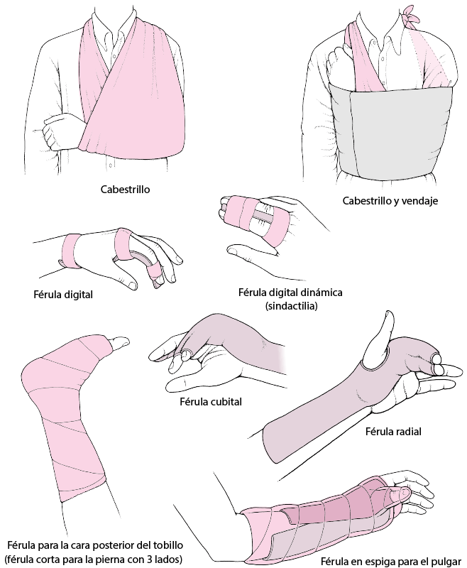 Generalidades sobre esguinces y otras lesiones de tejidos blandos ...