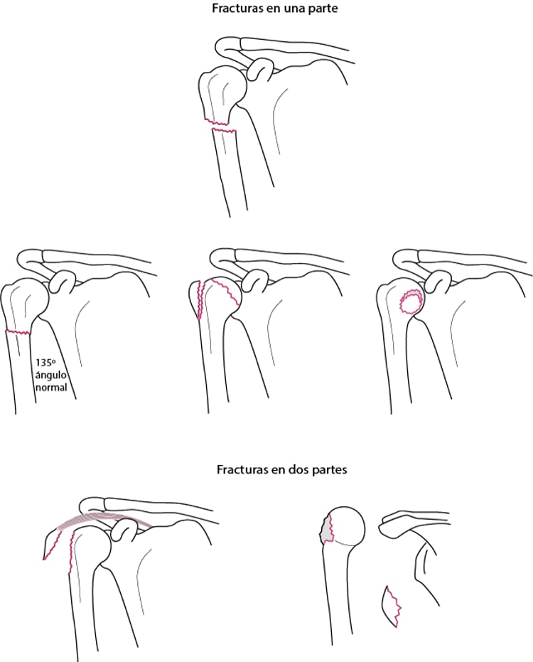Fracturas proximales del húmero - Lesiones y envenenamientos - Manual ...